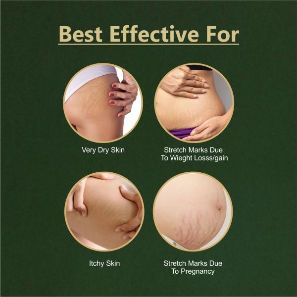 Abhigamyah Stretch Marks Scar removal oil in during after pregnancy ...