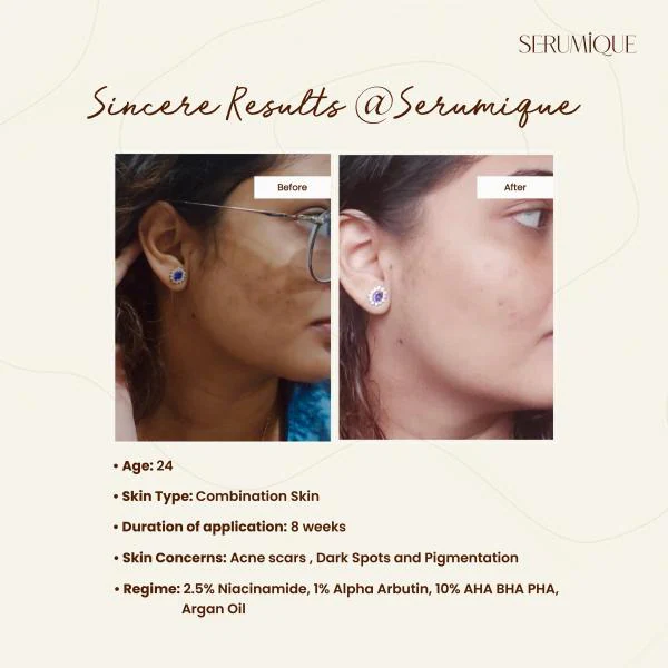 Serumique Niacinamide Face Serum| For Acne Scars, Excess Sebum & Oil ...